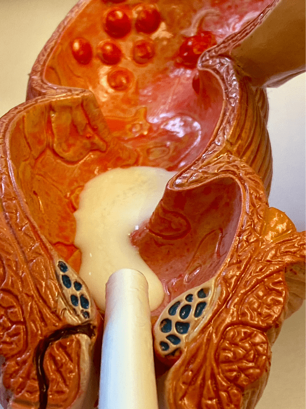 Prolapso rectal | Dra. Christian Torres Granados | Coloproctologia y Gastrocirugía | Cirugia ...